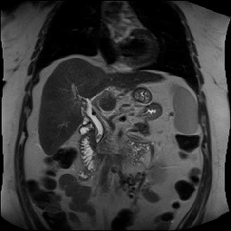 Choledocholithiasis Body Mr Case Studies Ctisus Ct Scanning
