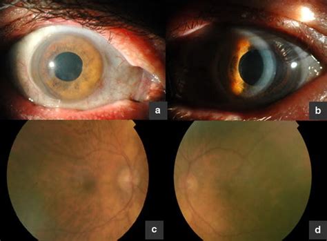 Conjunctival Discoloration Grayish Black Pigmentation In The Area Of