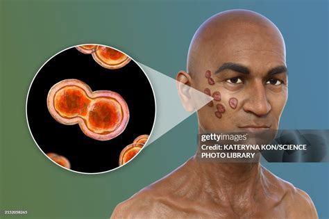 Cutaneous Blastomycosis 3d Illustration High Res Vector Graphic Getty