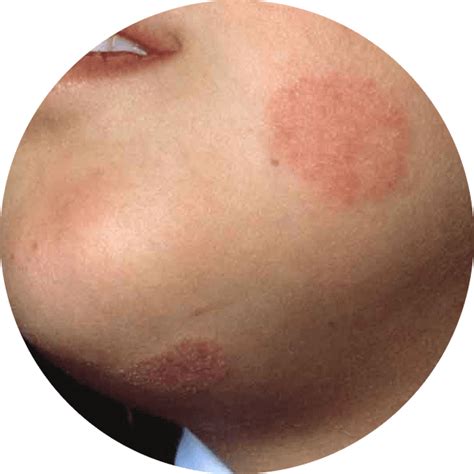 Is Ringworm Contagious When Healing At Joseph Larrick Blog