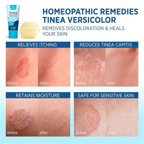 Tinea Versicolor Relief Cream And Soap Clinically Proven Treatment For