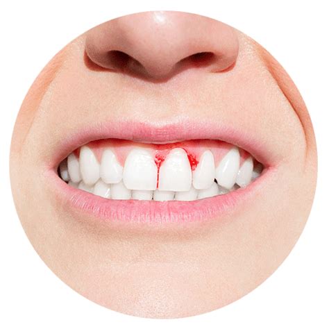 Hygiene Periodontal Gum Treatment Teeth Cleaning Gargrave