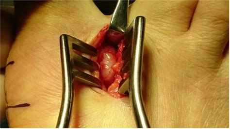 Large Neuroma In The First Web Space Download Scientific Diagram