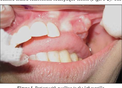 Figure 2 From Maxillary Osteosarcoma Two Case Reports And Literature Review Semantic Scholar