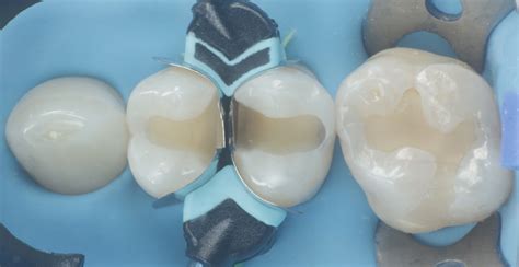 Back To Back Class Ii Restorations With The Quad Matrix System From Garrison Garrison Dental