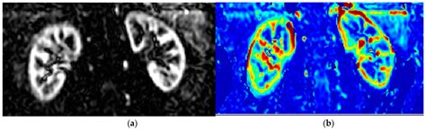Representative Perfusion Weighted Image A And The Resulting Rbf Map