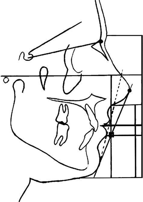Ricketts Esthetic Plane A Line Passing Through Pog′ To Pn