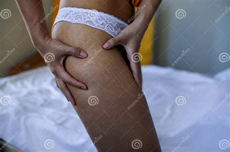 Stretch Marks On The Skin On The Hips Of A Girl Stretch Marks On Legs