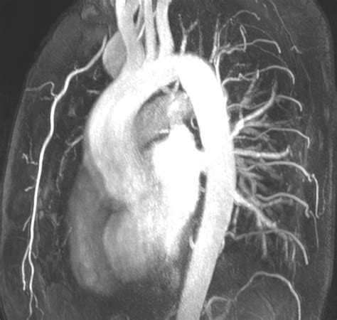 Magnetic Resonance Aortogram Download Scientific Diagram