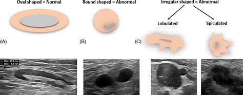 Groin Lymph Nodes Ultrasound