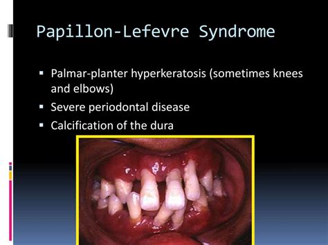 Ppt Periodontitis As A Manifestation Of Systemic Diseases Powerpoint