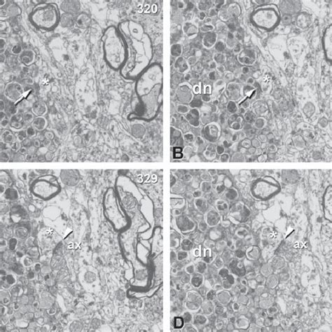 Tem Micrographs Showing Different Types Of Dystrophic Neurites In The