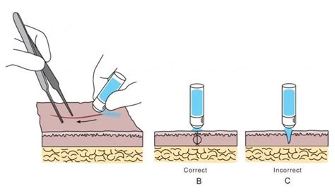 Skin Glue Dermabond