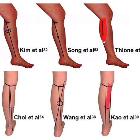 The Medial Sural Artery Perforator Msap Free Flap For Resurfacing The Download Scientific