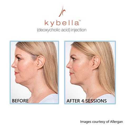 Kybella Grid Template