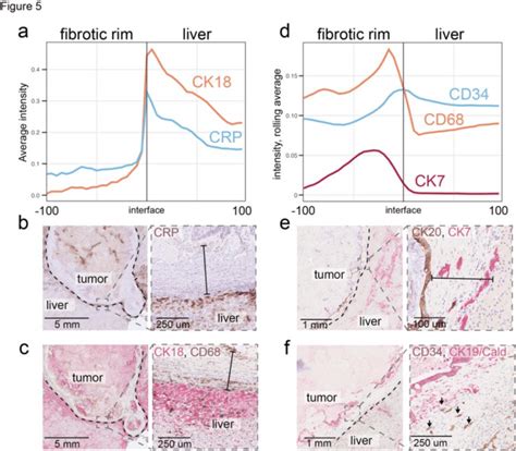 Protein Gradients In The Desmoplastic Rim A Quantification Of Crp And