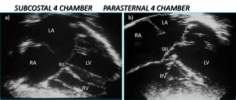 Echocardiography Sections From A Partial Atrioventricular Septal Defect Download Scientific