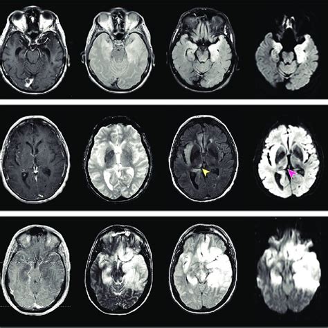 Illustrative Cases Of Patients With Herpes Simplex Encephalitis Download Scientific Diagram