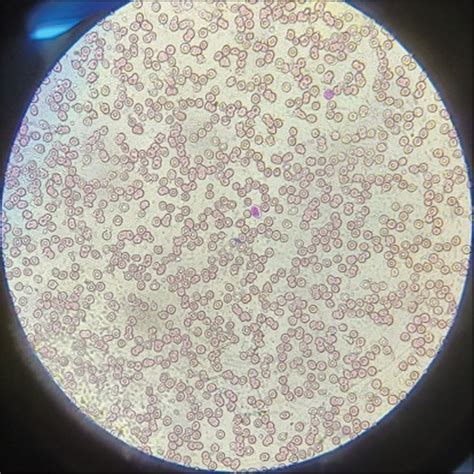 A Rare Coexistence Of Mycosis Fungoides And Myelodysplastic Neoplasm