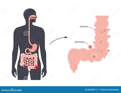 Diverticulitis En Diverticulose Vector Illustratie Illustration Of Laag Bloeding 285500111