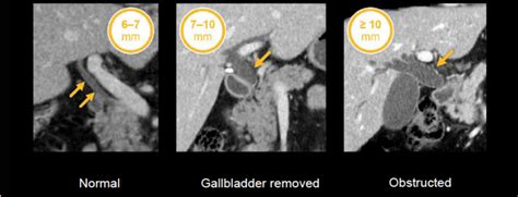 Abdominal Ct Biliary System And Pancreas • Litfl • Radiology