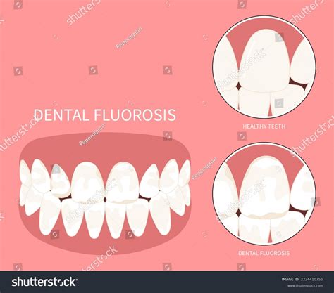 What Is Fluorosis Teeth At Natosha Guerro Blog