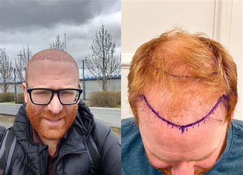 Svavar Segir Að Miklu Fleiri En Maður Heldur Hafi Farið í þessa Aðgerð „allir þessir Frægu“ Dv