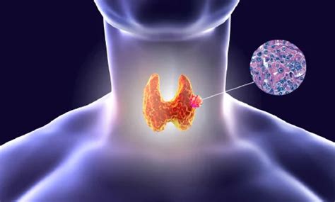 Thyroidectomy Thyroid Removal Surgery Ck Birla Hospital
