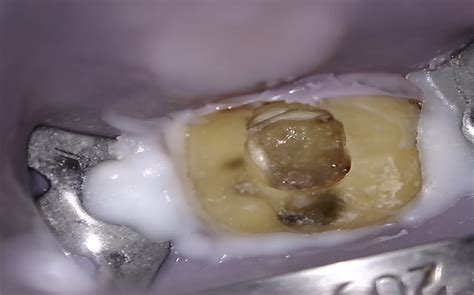 Clinical Tips For Managing Calcified Canals