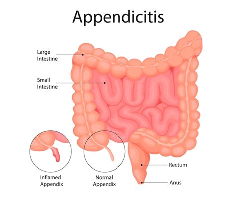 Appendicitis Is An Inflammation Of The Appendix Anatomical Illustration Premium Vector