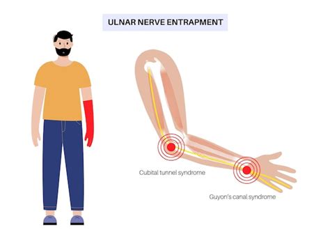 Premium Vector Ulnar Nerve Entrapment