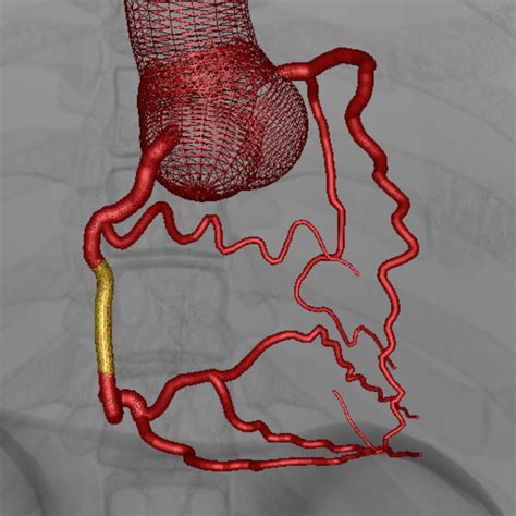 Percutaneous Coronary Intervention Pci Cathi Percutaneous Coronary Intervention Pci Cathi