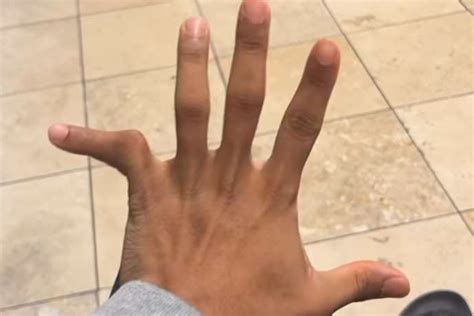 Deformed Pinky Finger Of Cardinals Wr That Gives Even The Sanest Of