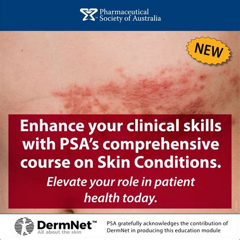 Jarrod Mcmaugh On Linkedin Mild Plaque Psoriasis And Herpes Zoster