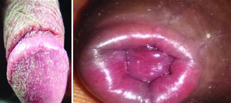 A Superficial Exfoliated Pustules Over Glans With Underlying Erythema Download Scientific