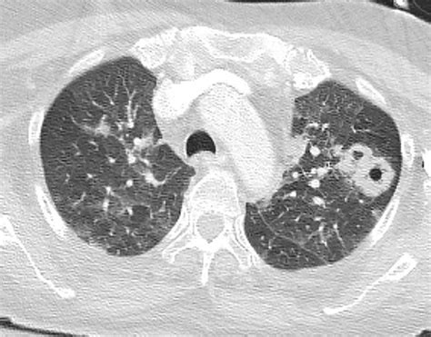Emphysematous Osteomyelitis Applied Radiology