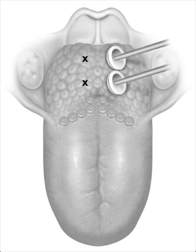 Radiofrequency Tongue Base Reduction In Sleep Disordered Breathing