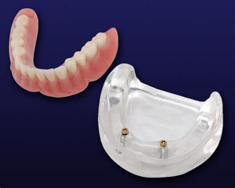 Locator Dentures Stoller Dental Lab