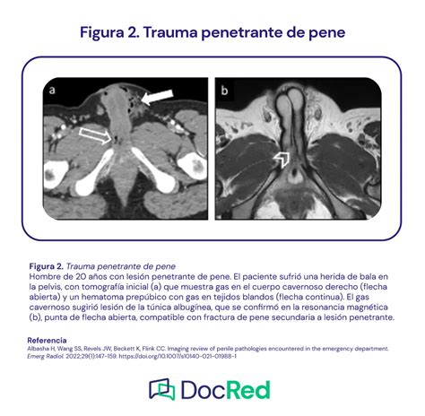 Resonancia Magnética De La Anatomía Del Pene Anatomía Radiológica