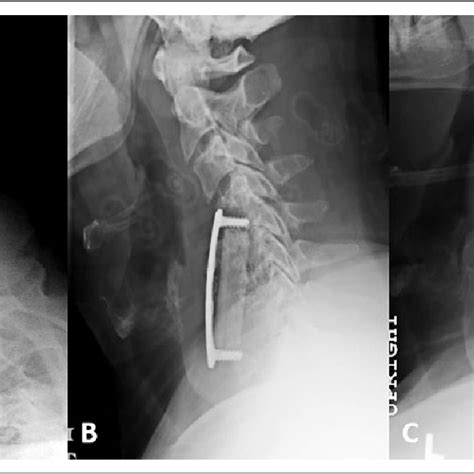 A Patient With Progressive Myelopathy Underwent A C5 And C6