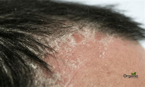 Scalp Psoriasis क्या है स्कैल्प सोरायसिस की पूरी जानकारी