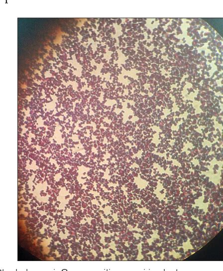 Figure 2 From Umbilical Pilonidal Sinus A Rare Presentation