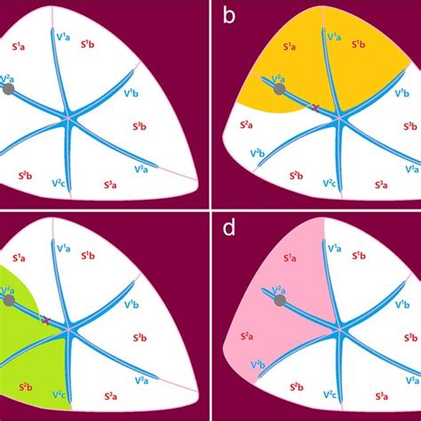 Schematic Diagram Of Extended Segmentectomy And Combined Download