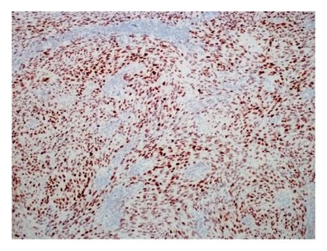 Diffuse Positive Staining Of Tumor Cells Immunohistochemically With A Download Scientific