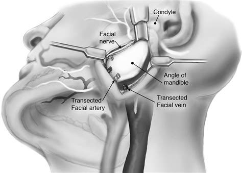 Condylar Fractures Otolaryngologic Clinics Of North America