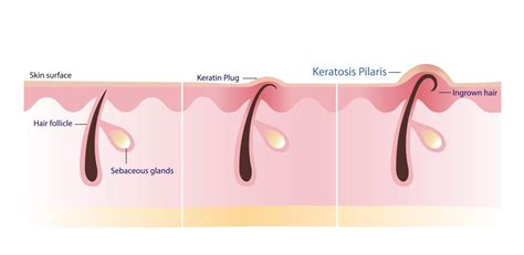 Ingrown Hair Causes Treatment And Prevention