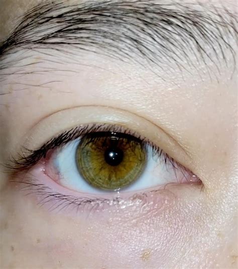 Brown Or Hazel Central Heterochromia R Eyes