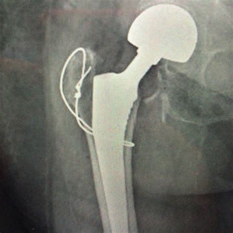 Periprosthetic Fracture A According To Vancouver Classification