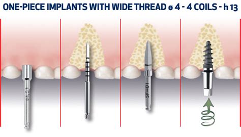 One Piece Implants With Wide Thread Tecnomed
