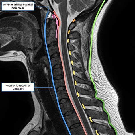 Anterior Longitudinal Ligament Calcification Airway Management For